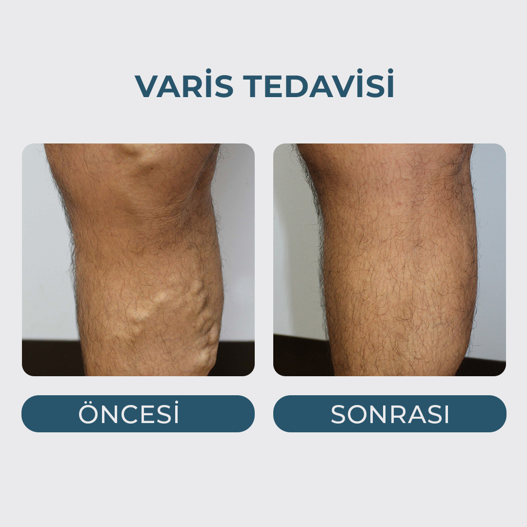 Varis Tedavisi – Prof. Dr. Kazım Beşirli